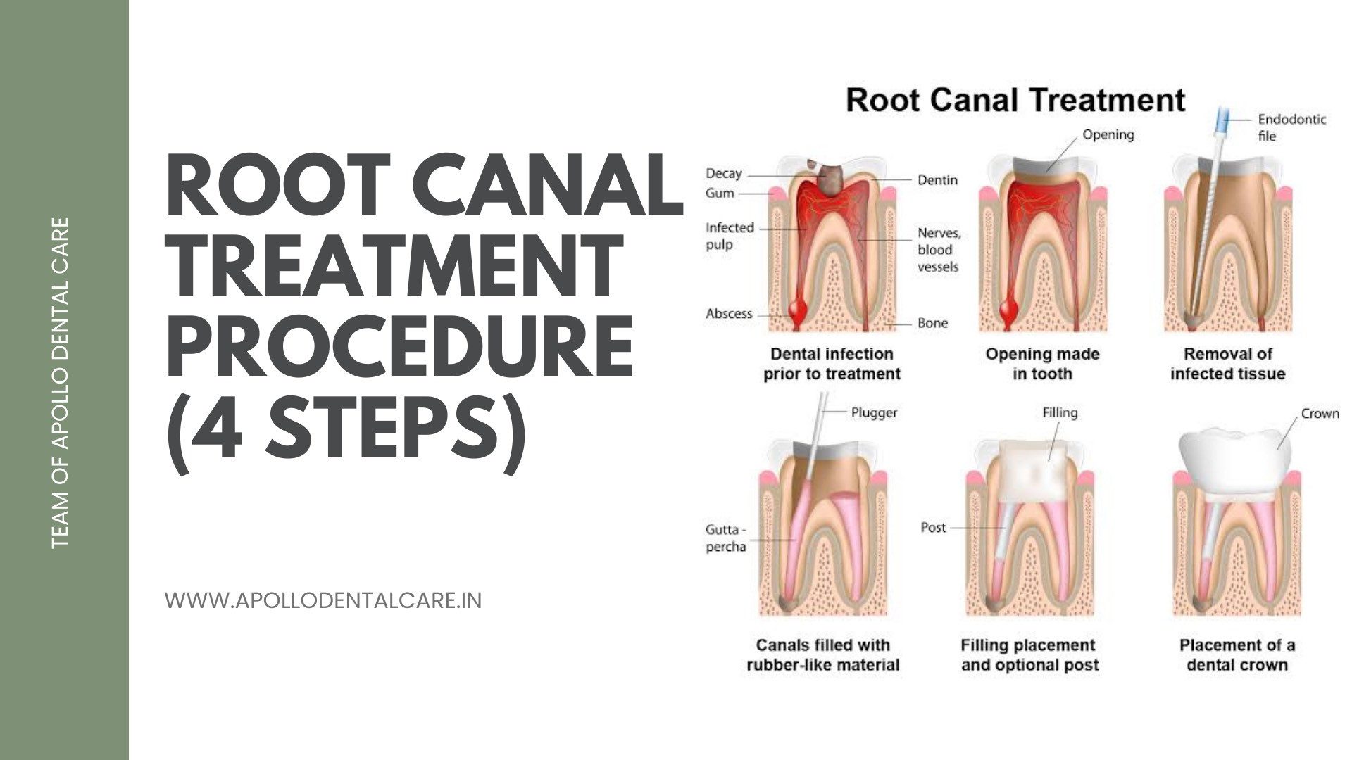 Tooth Root Canal Procedure Tooth Pain After Root Canal Therapy The 5 Tooth Root Canal Procedure Tooth Pain After Root Canal Therapy The 5
